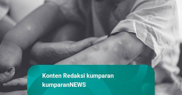 BREAKING NEWS: Indonesia Catat Kasus Pertama Cacar Monyet | kumparan.com